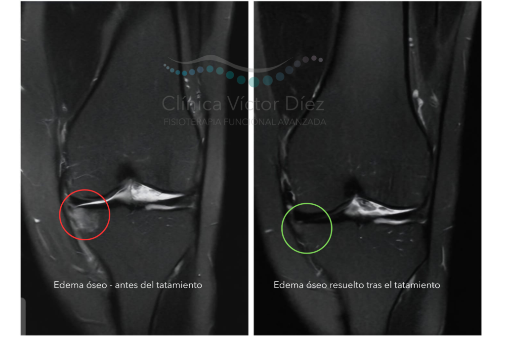Edema óseo: Qué es, síntomas, tratamiento y recuperación